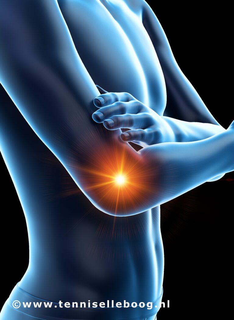 Therapie - Tennisarm